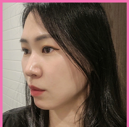 Buccal Fat Thread Lift in Korea - PangPang Clinic in Gangnam