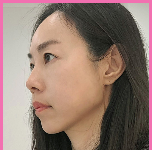 Buccal Fat Thread Lift in Korea - PangPang Clinic in Gangnam