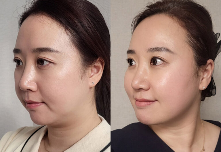 Before & After Photos - PangPang Thread Lifting Clinic in Korea