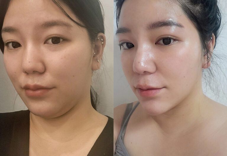 Before & After Photos - PangPang Thread Lifting Clinic in Korea